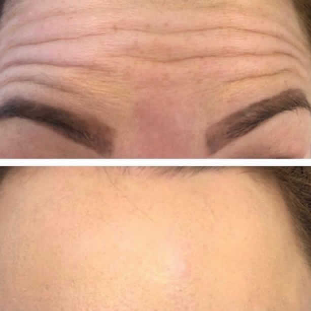 Aesthetics Portfolio | Elizabeth Tetlow's Aesthetics Macclesfield, Cheshire